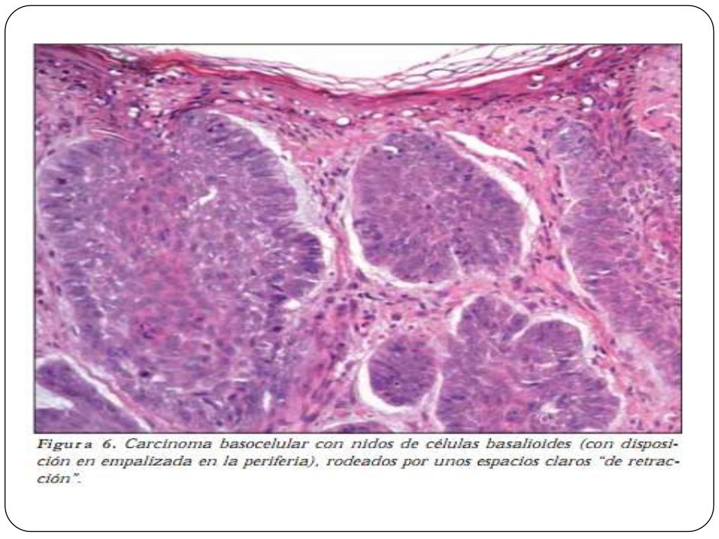 Carcinoma basocelular