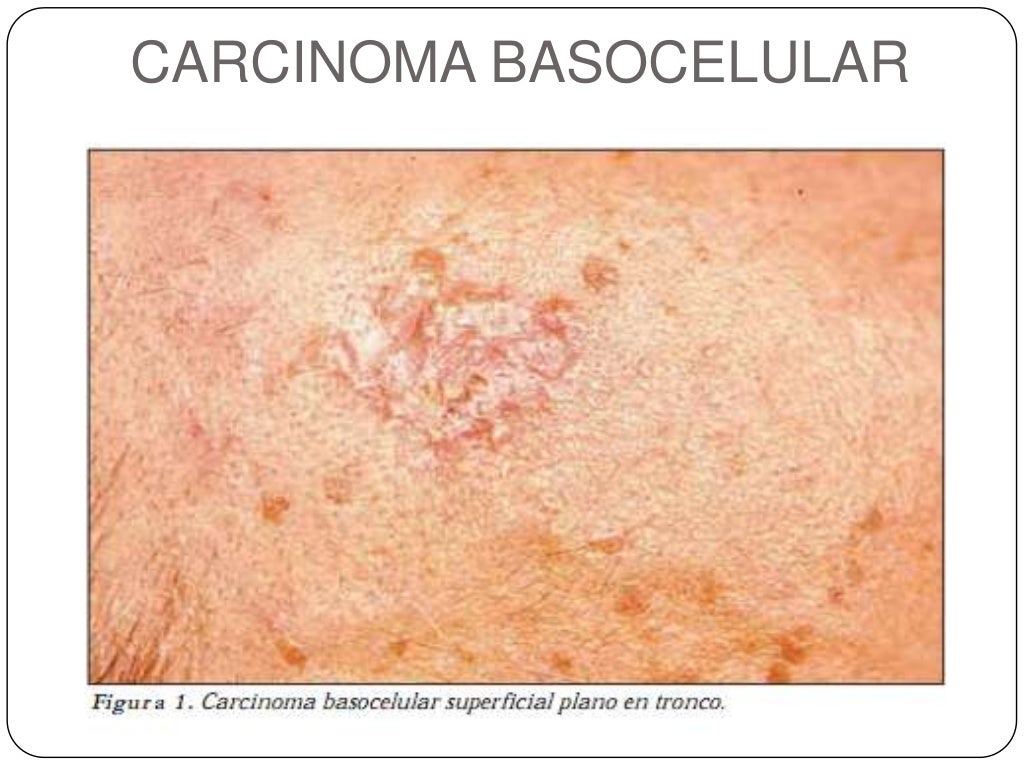Carcinoma basocelular