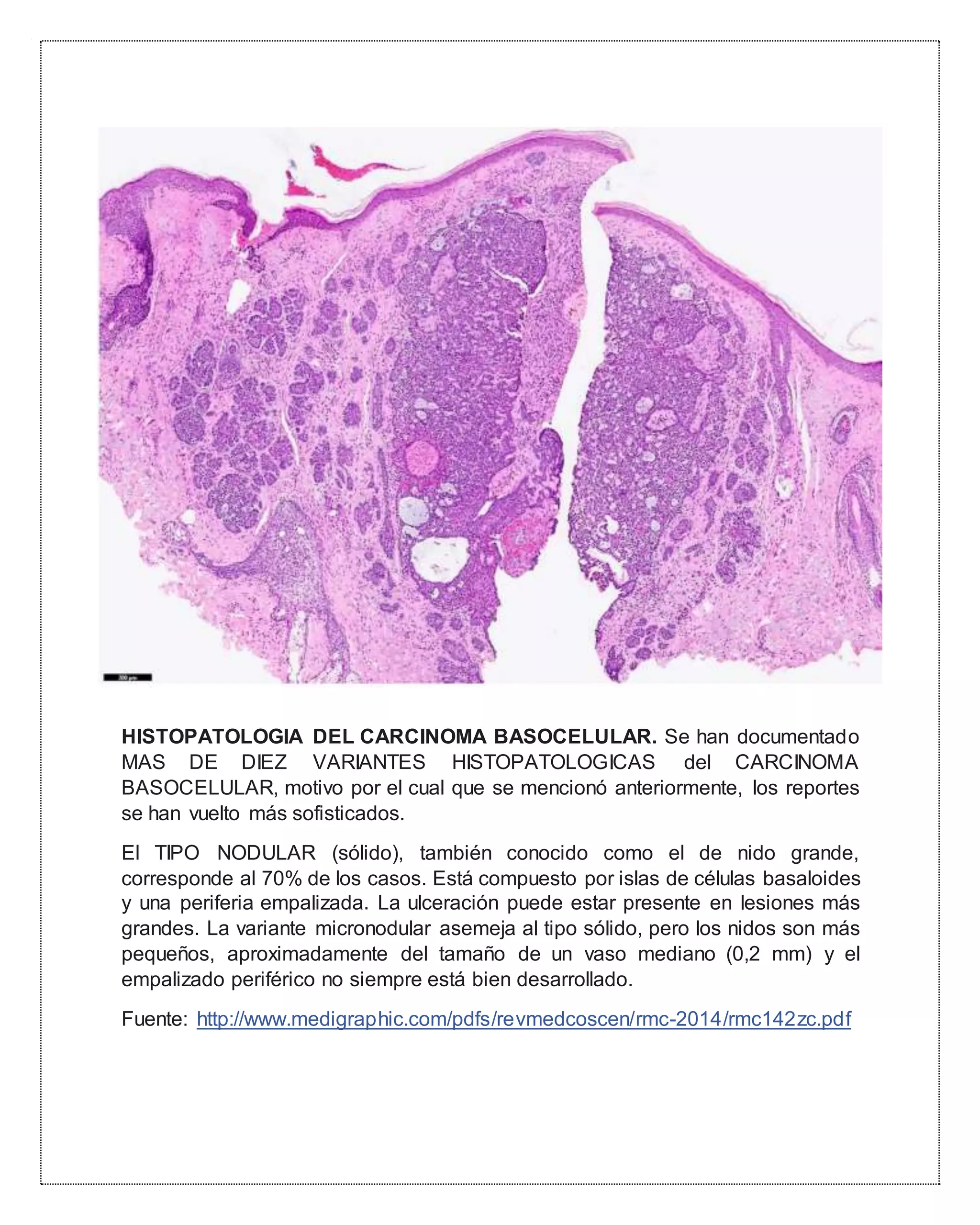 CARCINOMA BASOCELULAR EN ALA NASAL | DOCX