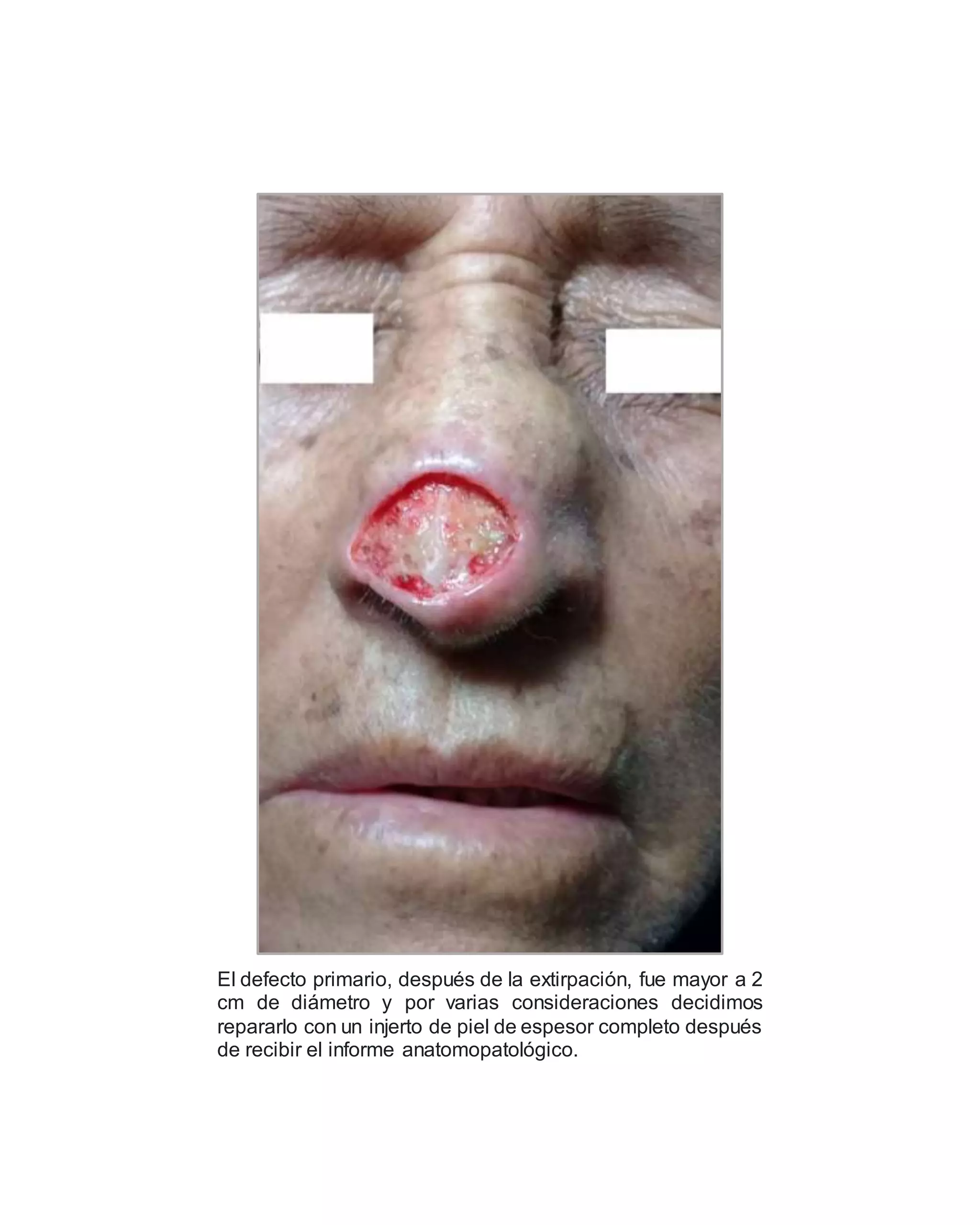 Carcinoma basocelular en punta nasal | DOCX