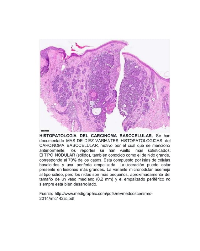 Carcinoma basocelular en punta nasal | DOCX