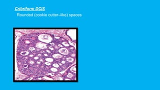 Pathology and management of carcinoma breast | PPTX