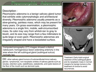 Carcinoma buccal mucosa | PPTX
