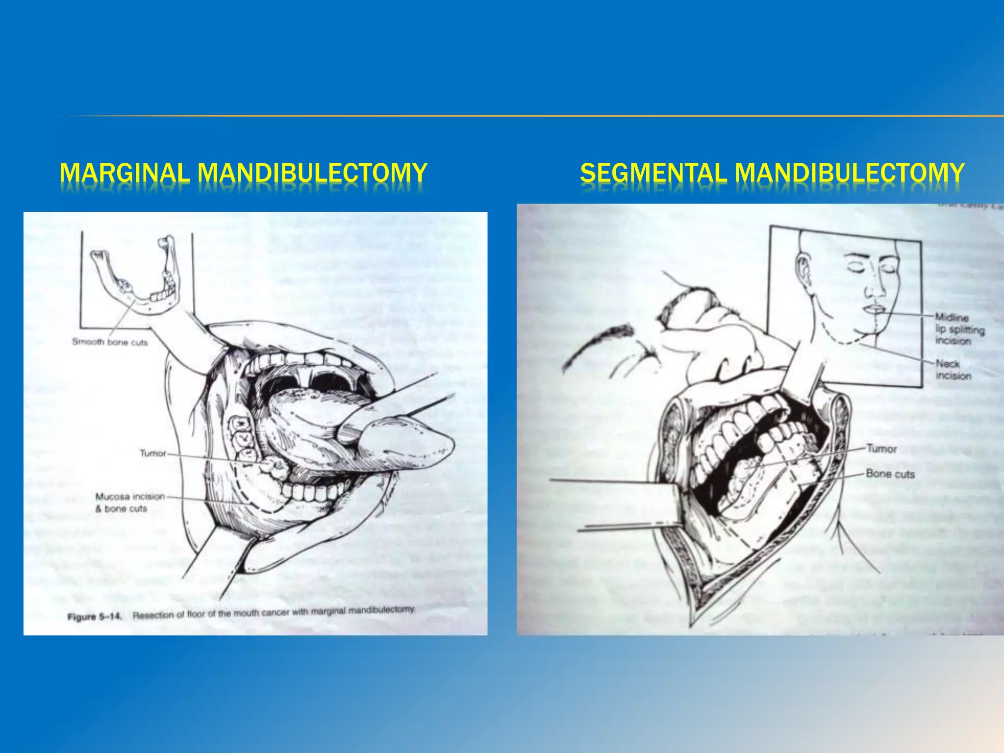 Carcinoma buccal mucosa | PPTX