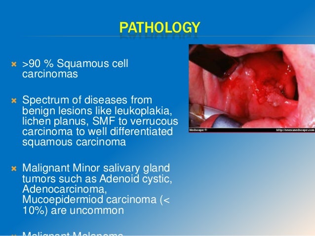 Carcinoma buccal mucosa