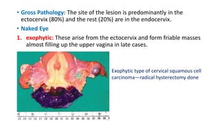Carcinoma Cervix.pptx