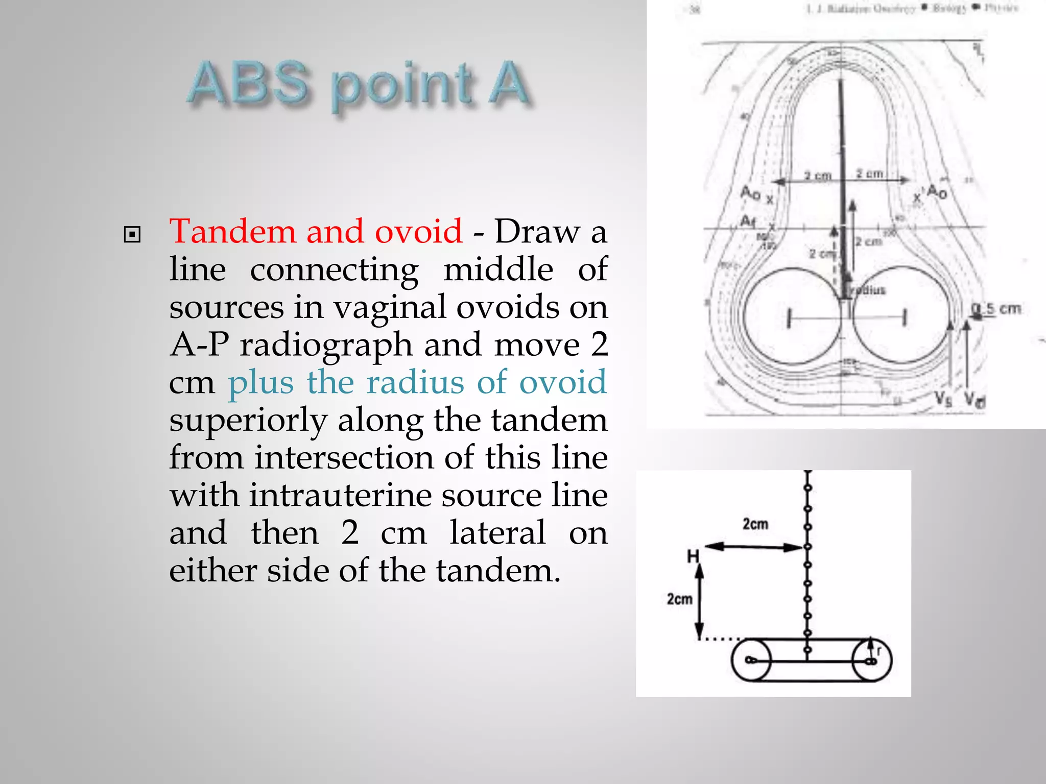 Carcinoma cervix brachytherapy- dr upasna | PPTX