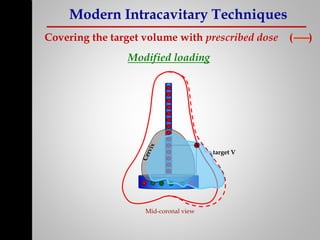 Carcinoma cervix brachytherapy- dr upasna | PPTX