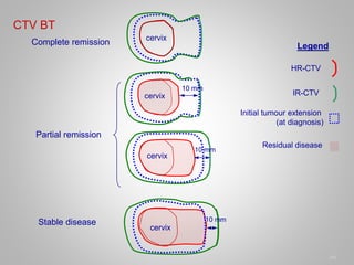 Carcinoma cervix brachytherapy- dr upasna | PPTX