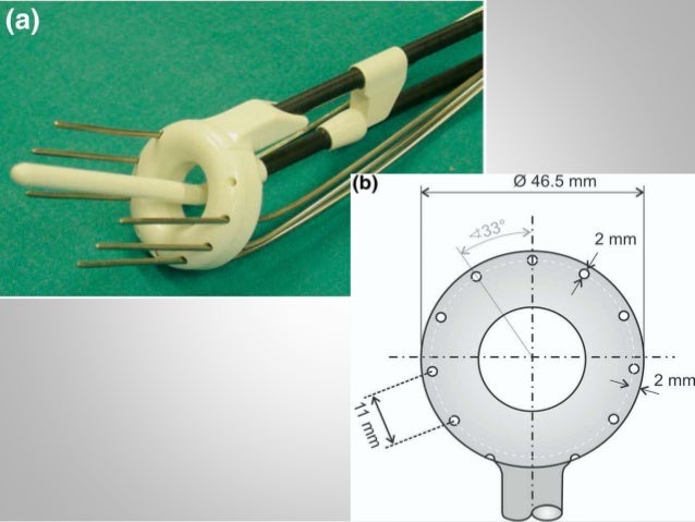 Carcinoma cervix brachytherapy- dr upasna