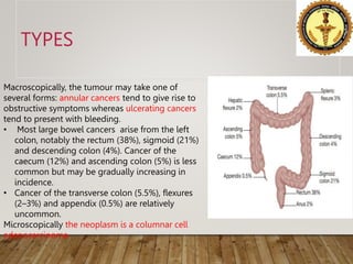 Carcinoma Colon (large intestine ).pptx