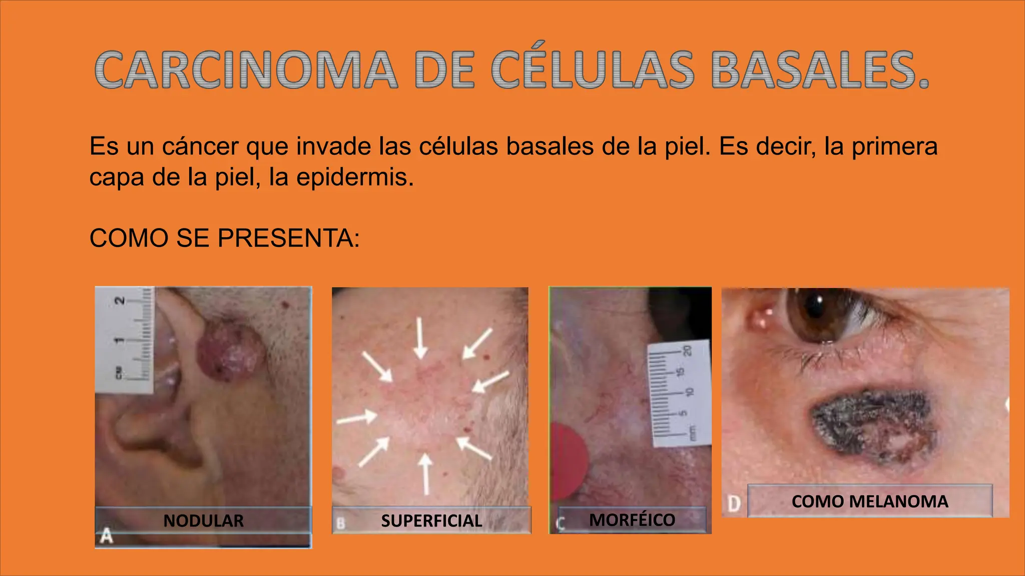 CARCINOMA DE CELULAS BASALES.pptx | Skin and Dermatology | Diseases and ...