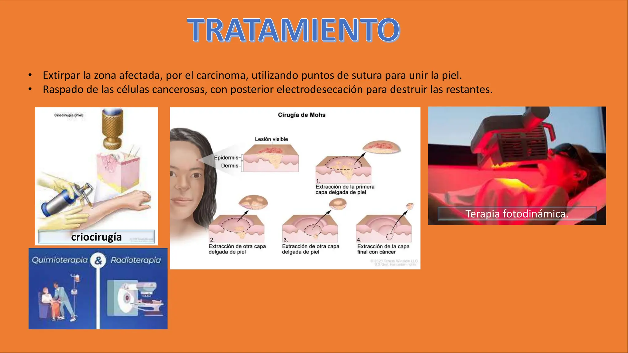 CARCINOMA DE CELULAS BASALES.pptx