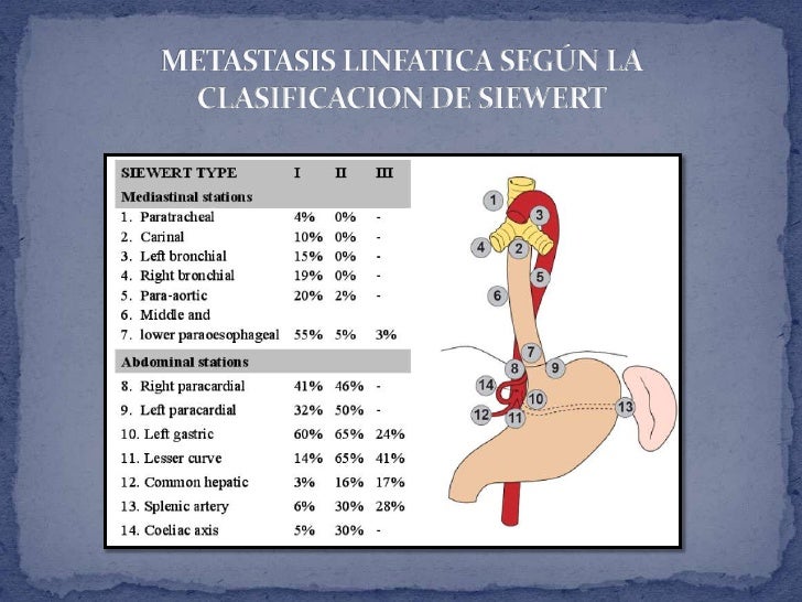 Carcinoma de la union gastroesogafica