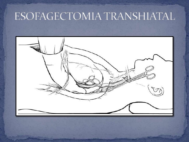 Carcinoma de la union gastroesogafica