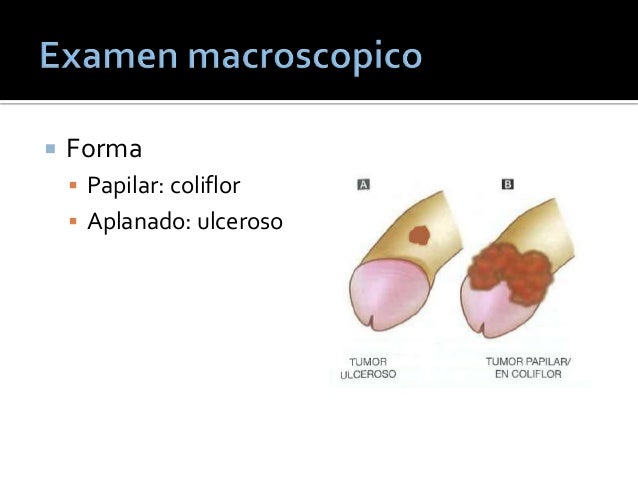 Carcinoma de pene