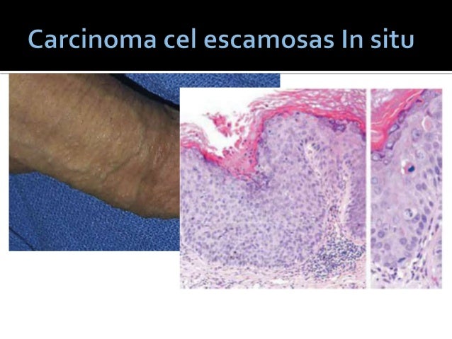 Carcinoma de pene