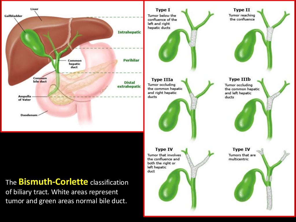 Cancer De Vesicula Biliar