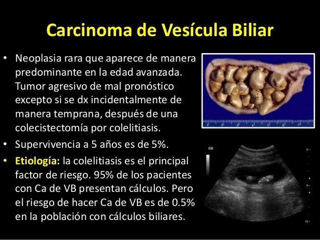 Carcinoma de Vesícula Biliar y Colangiocarcinoma