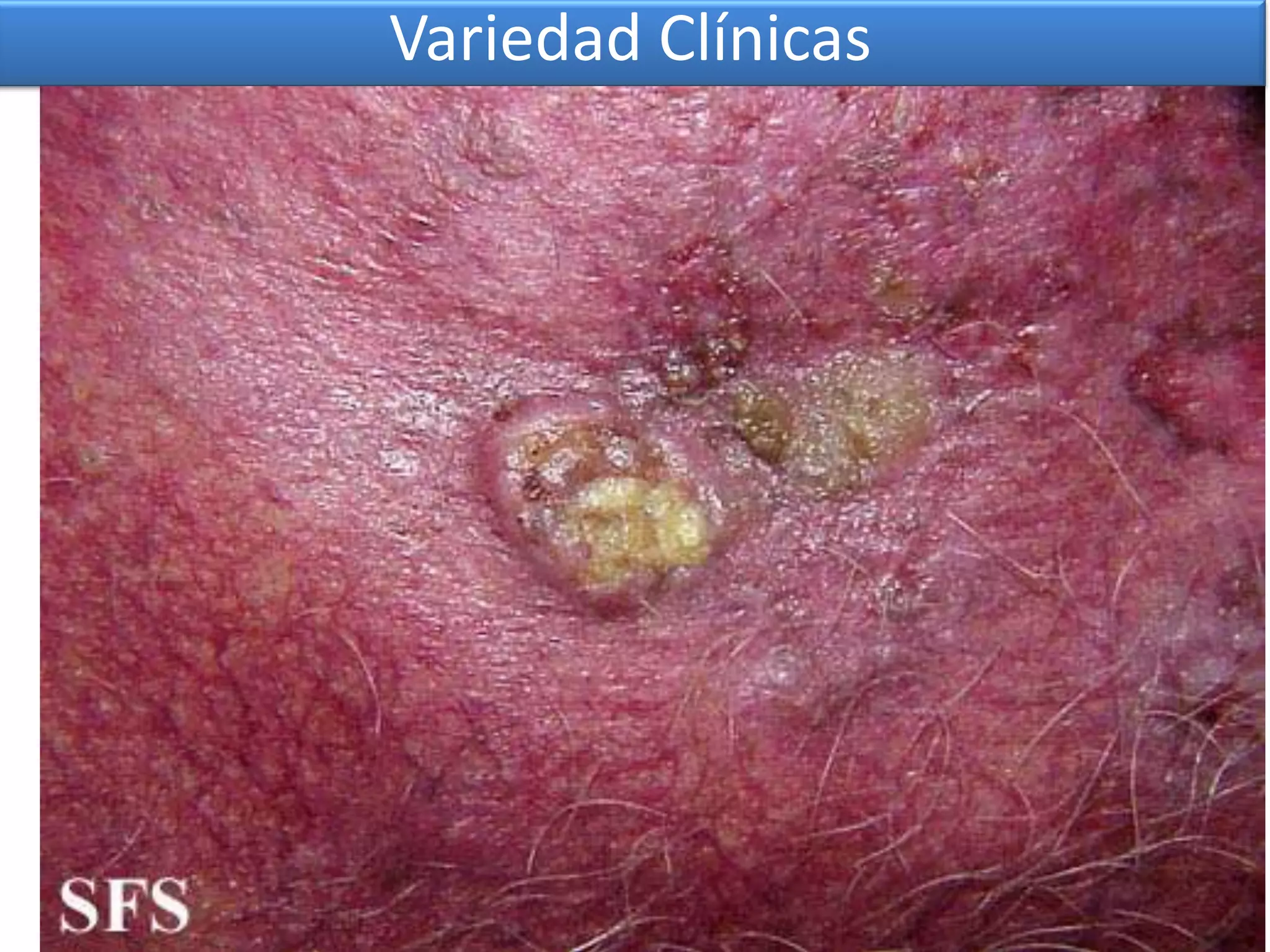 Carcinoma epidermoide | PPTX