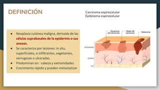 CARCINOMA EPIDERMOIDE Dermatología Clínica | PPTX