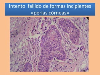Carcinoma epidermoide can dulce | PPTX
