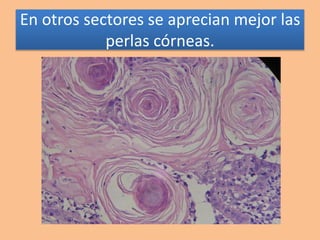 Carcinoma epidermoide can dulce | PPTX