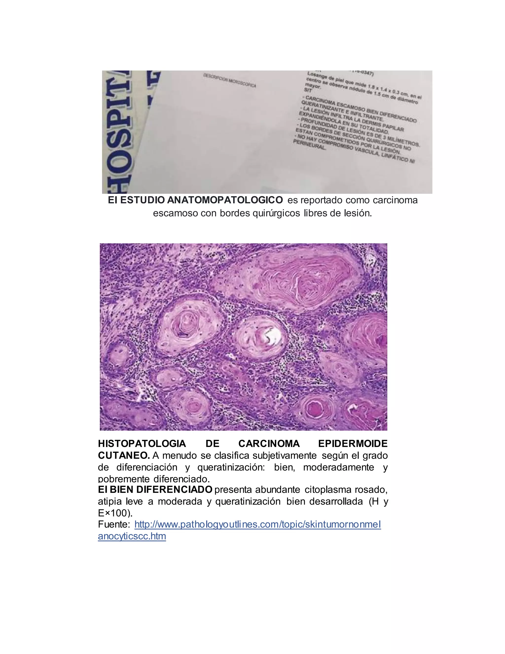 Carcinoma epidermoide cutaneo | PDF