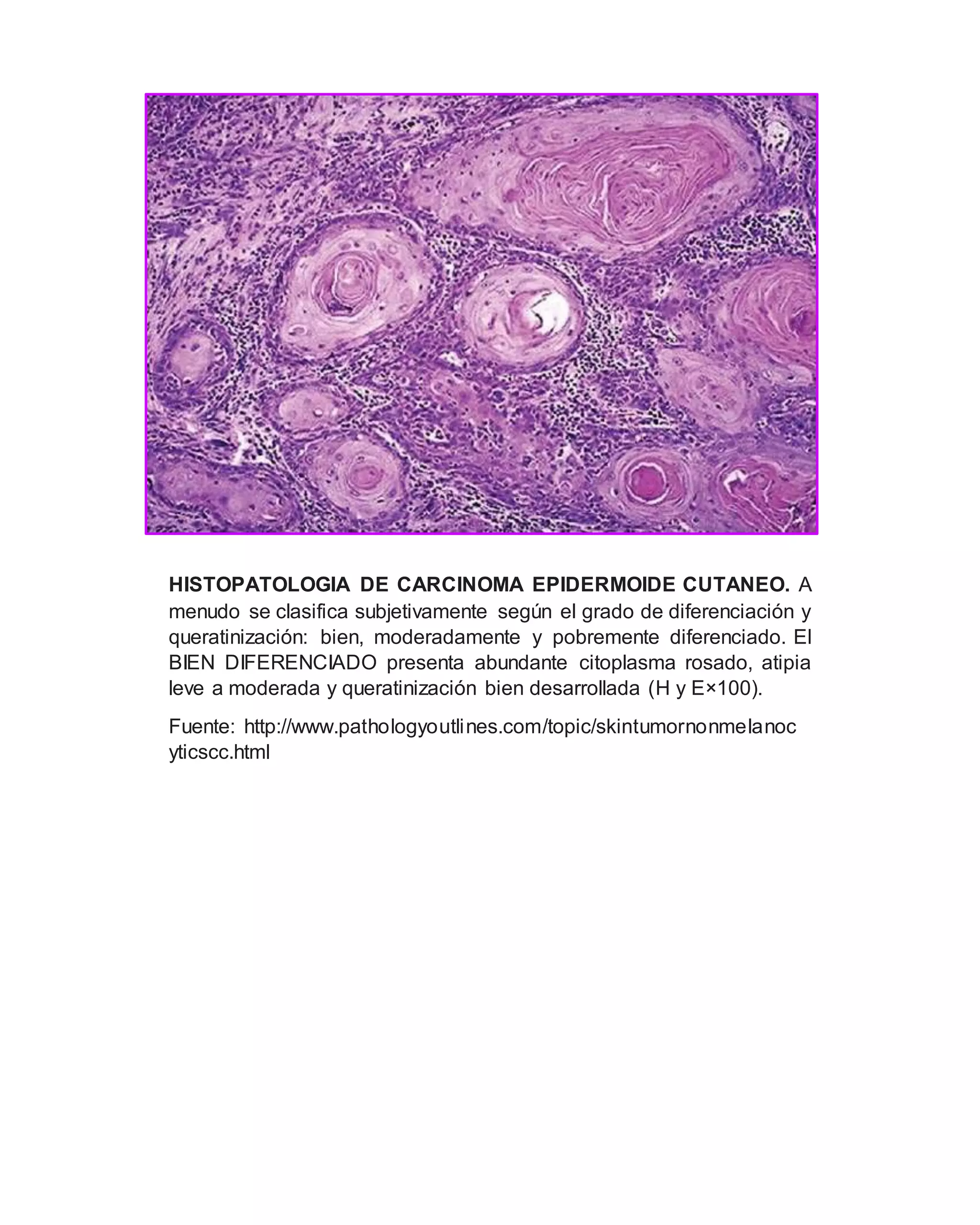 Carcinoma epidermoide cutaneo | PDF