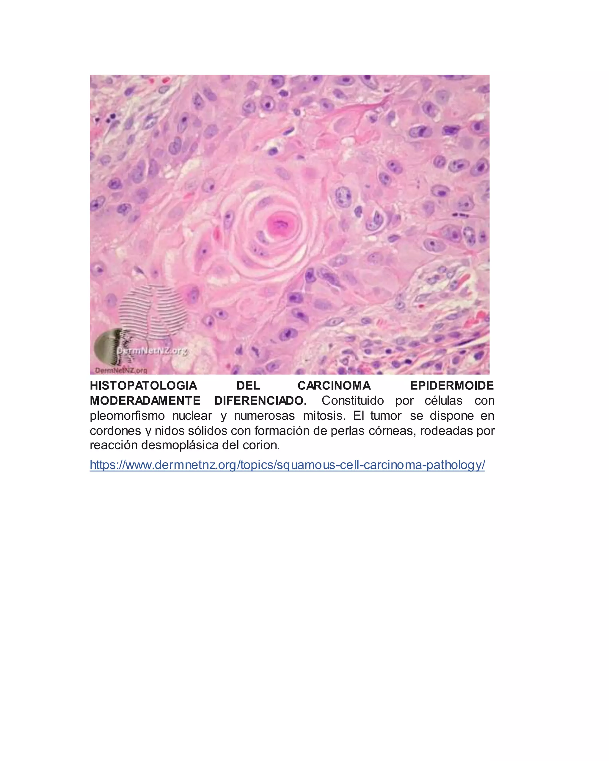 Carcinoma epidermoide cutaneo en la region temporal derecha | DOCX