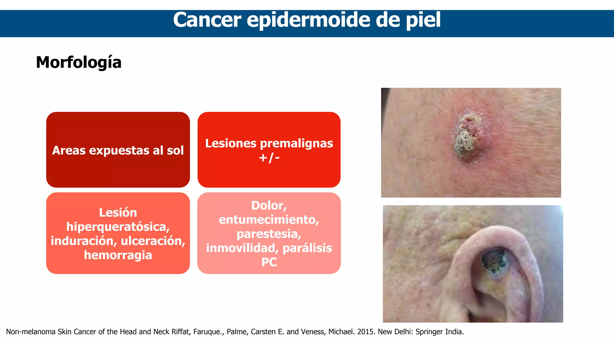Carcinoma epidermoide de piel | PPTX | Skin and Dermatology | Diseases ...