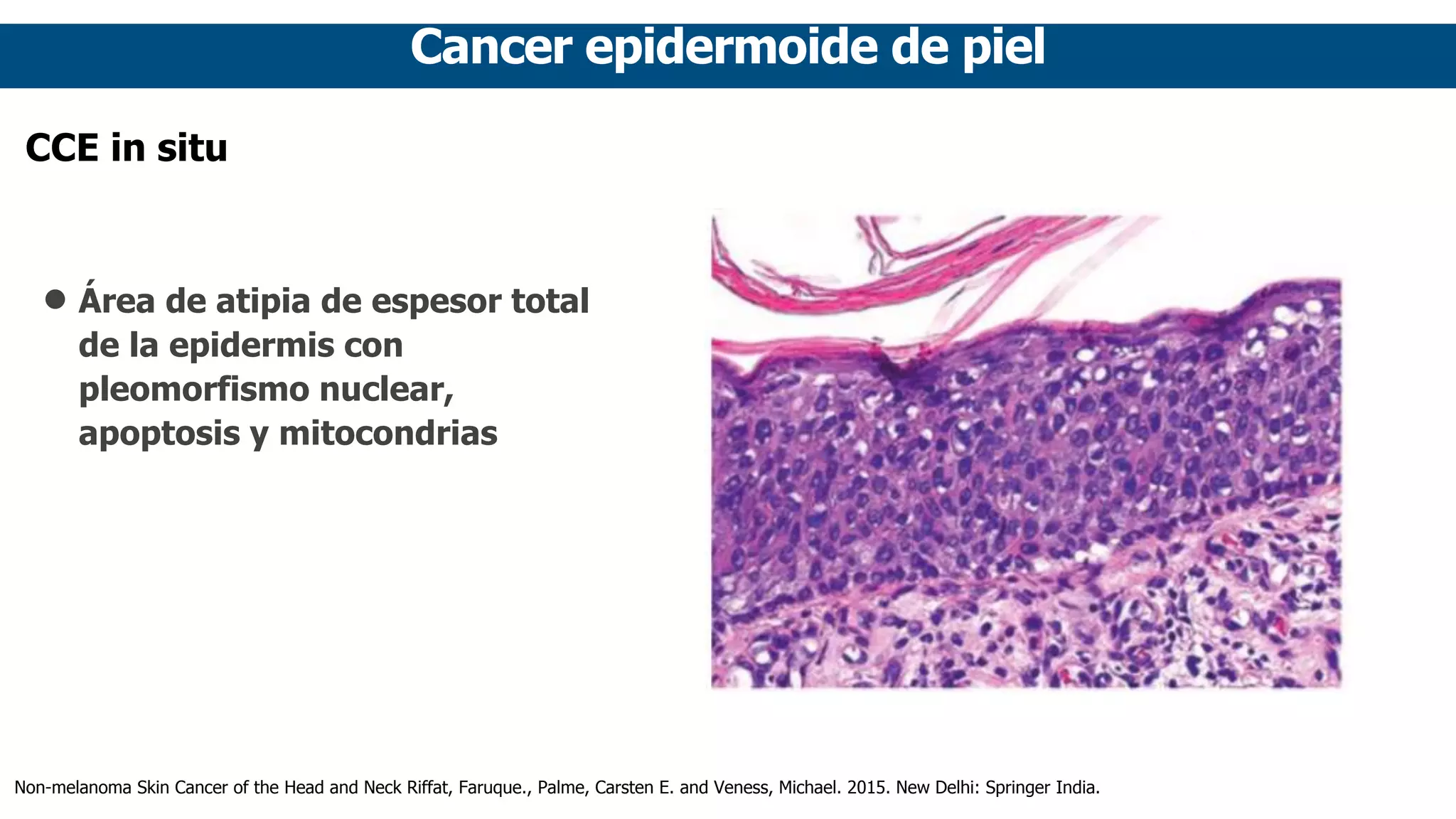 Carcinoma epidermoide de piel | PPTX | Skin and Dermatology | Diseases ...