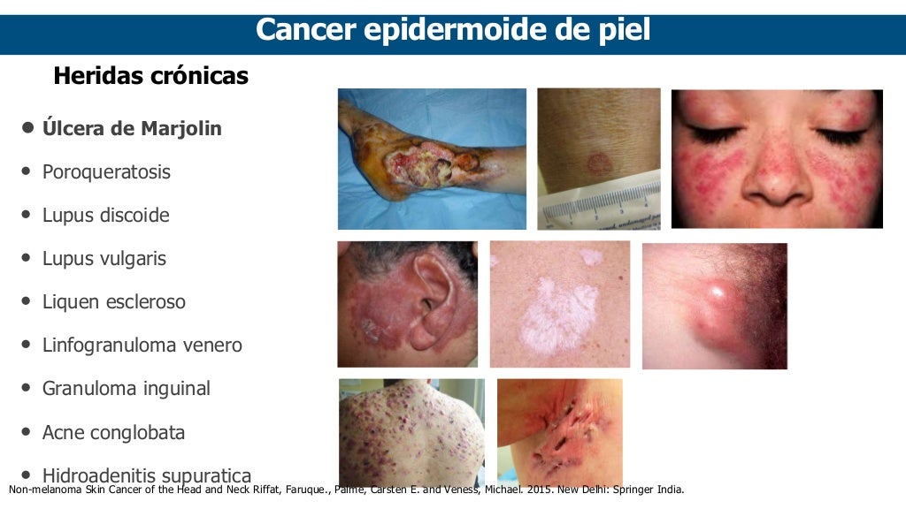 Epidermoide