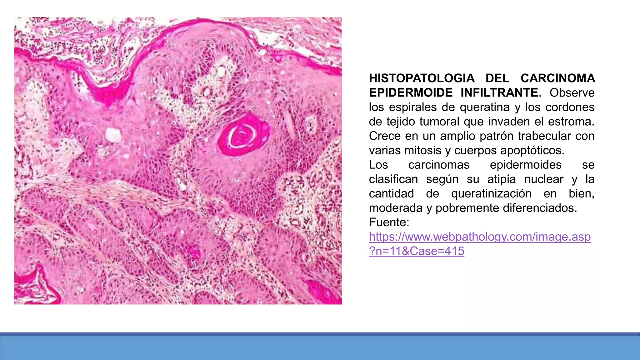 CARCINOMA EPIDERMOIDE INFILTRANTE EN MEJILLA. | PPTX | Skin and ...