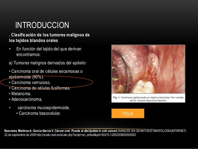 Carcinoma epidermoide oral y orofaríngeo