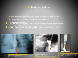 Esophageal Cancer Barium Swallow