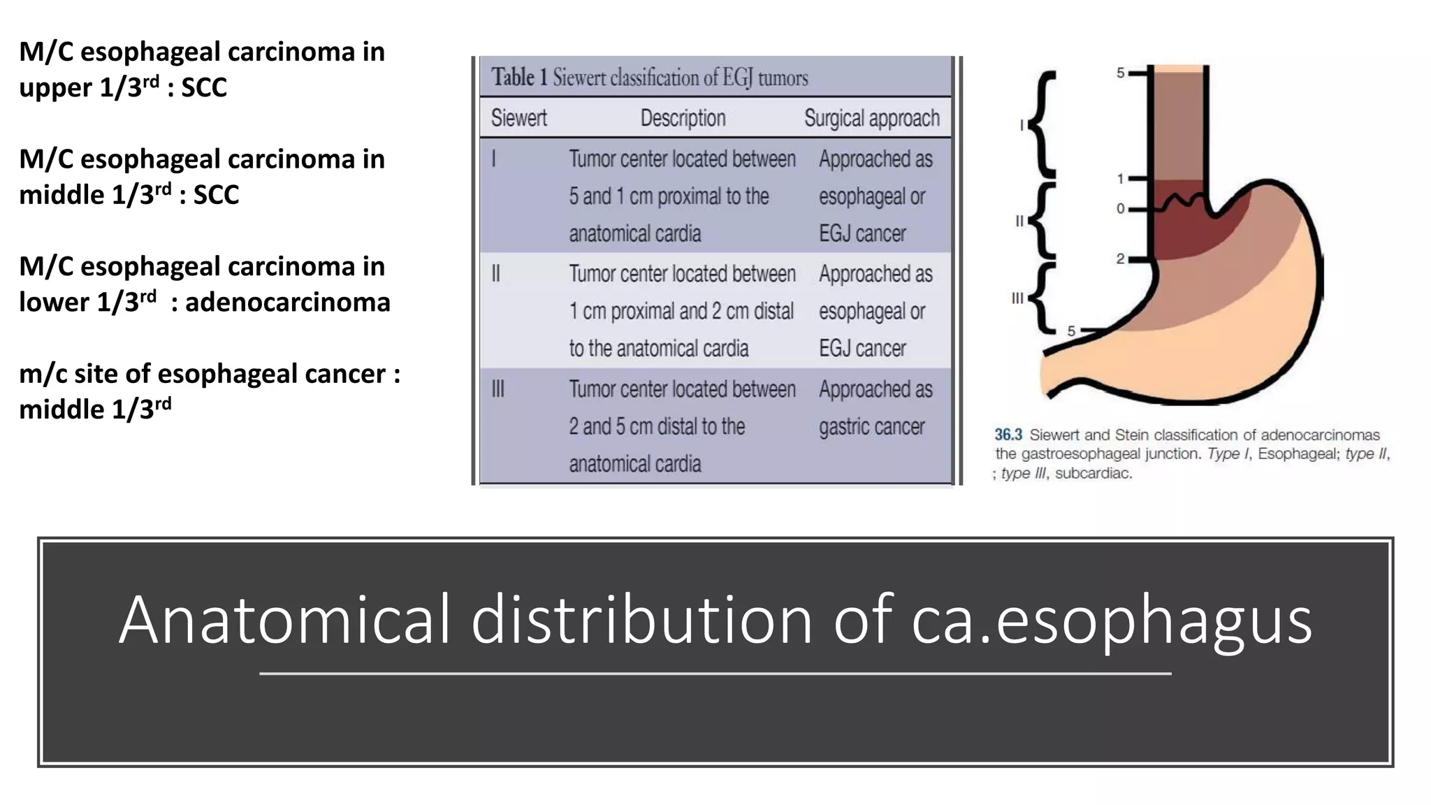 Carcinoma esophagus 2020 | PPTX