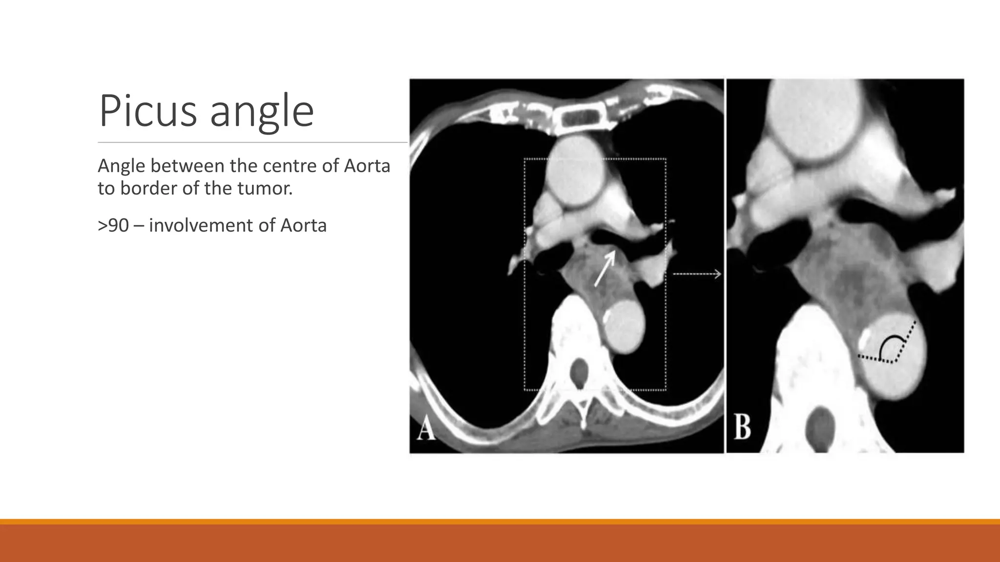 Carcinoma Esophagus new.pptx