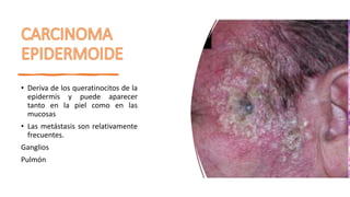 CARCINOMA ESPINOCELULAR.GENERALIDADES.DR