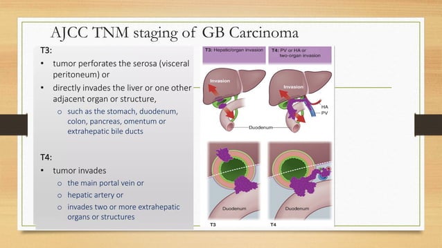 Carcinoma Gall Bbladder,introduction,pathogenesis,diagnosis,managment ...