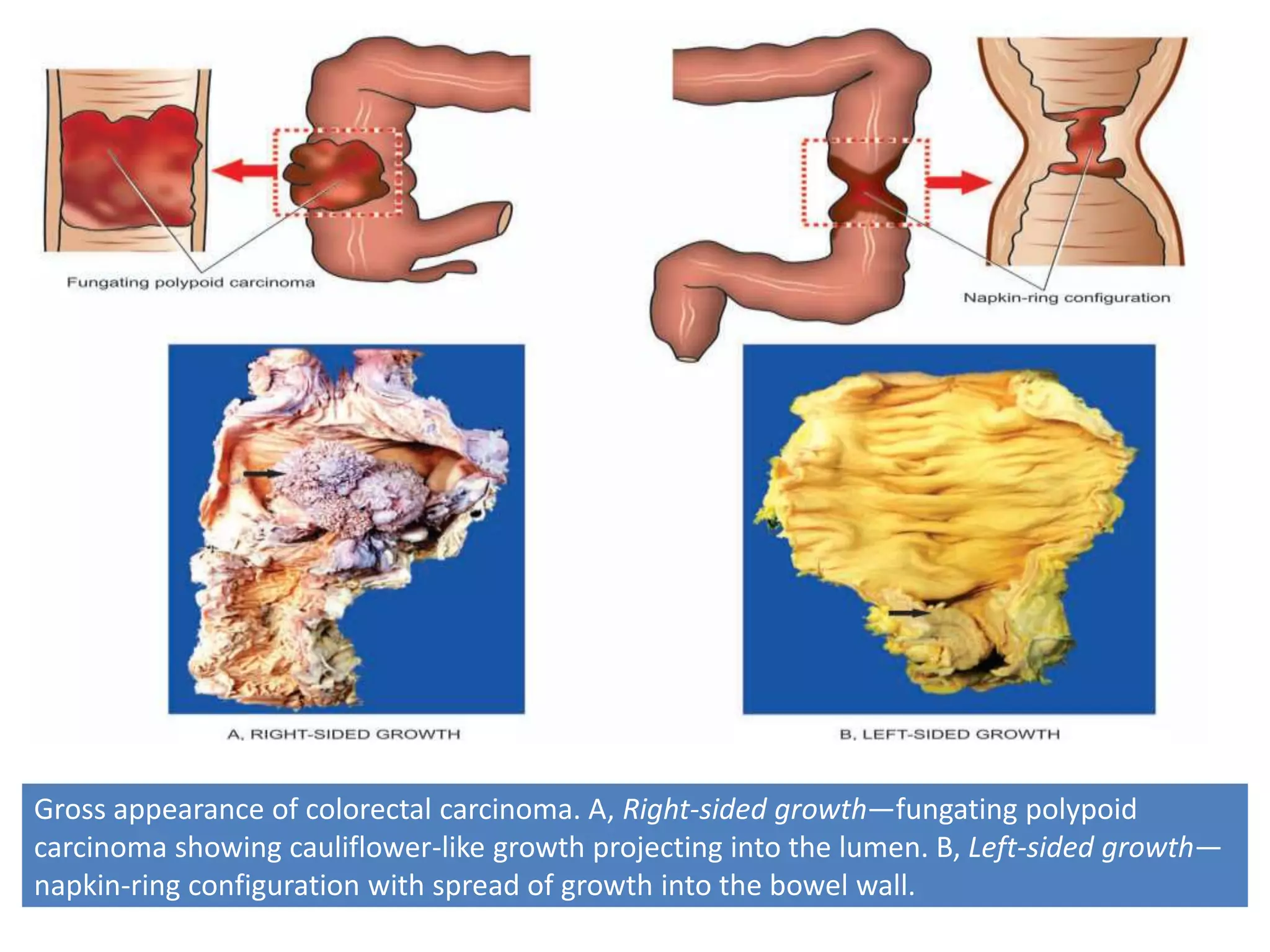 Carcinoma GI tract- Buccal, Esophagial, Gastric & intestinal.pptx
