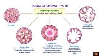 Breast carcinoma in situ - Dr.V.Shanthi | PPTX