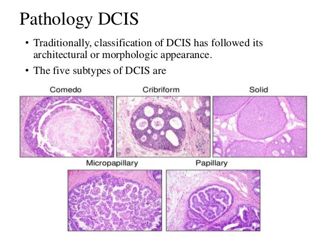 Breast: Carcinoma in situ management