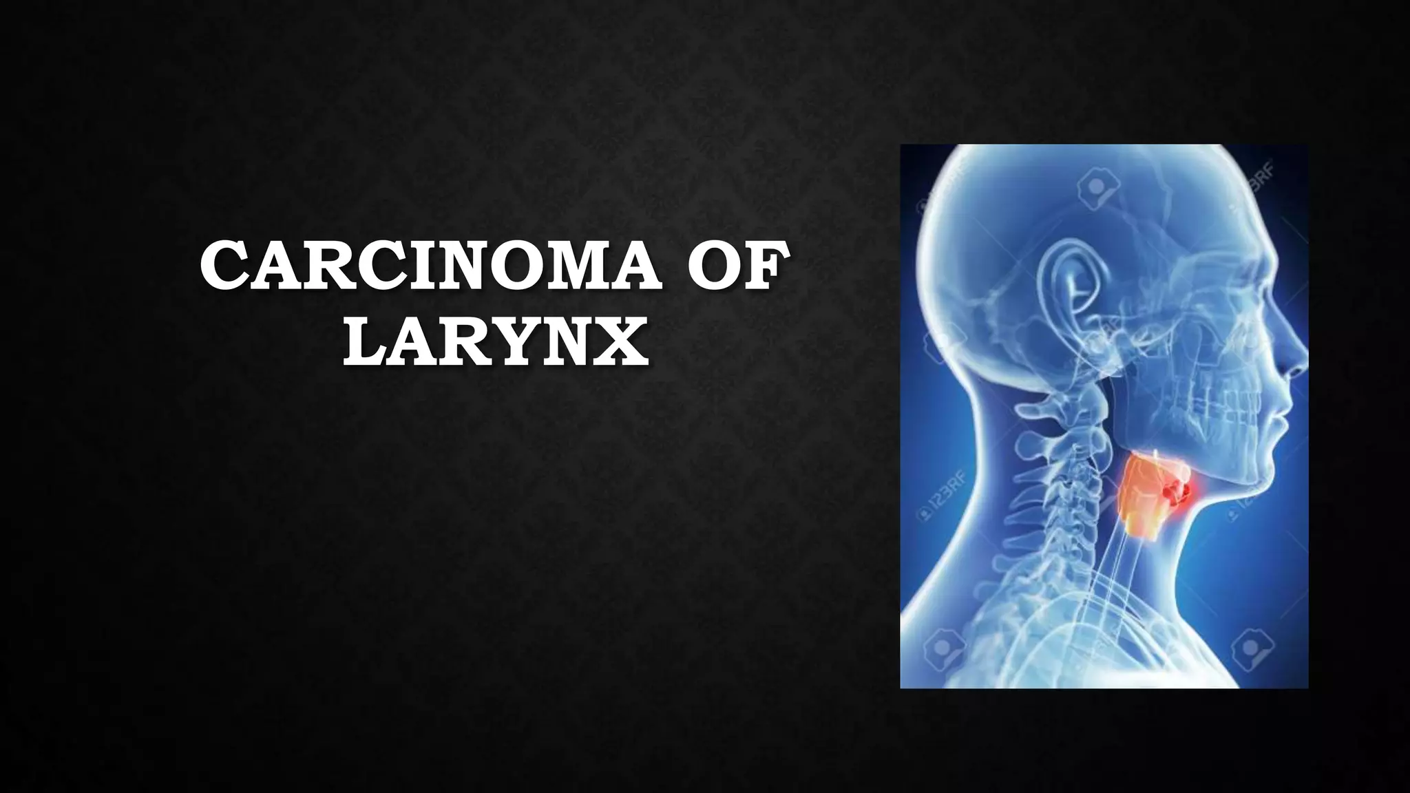 Carcinoma Larynx Ppt