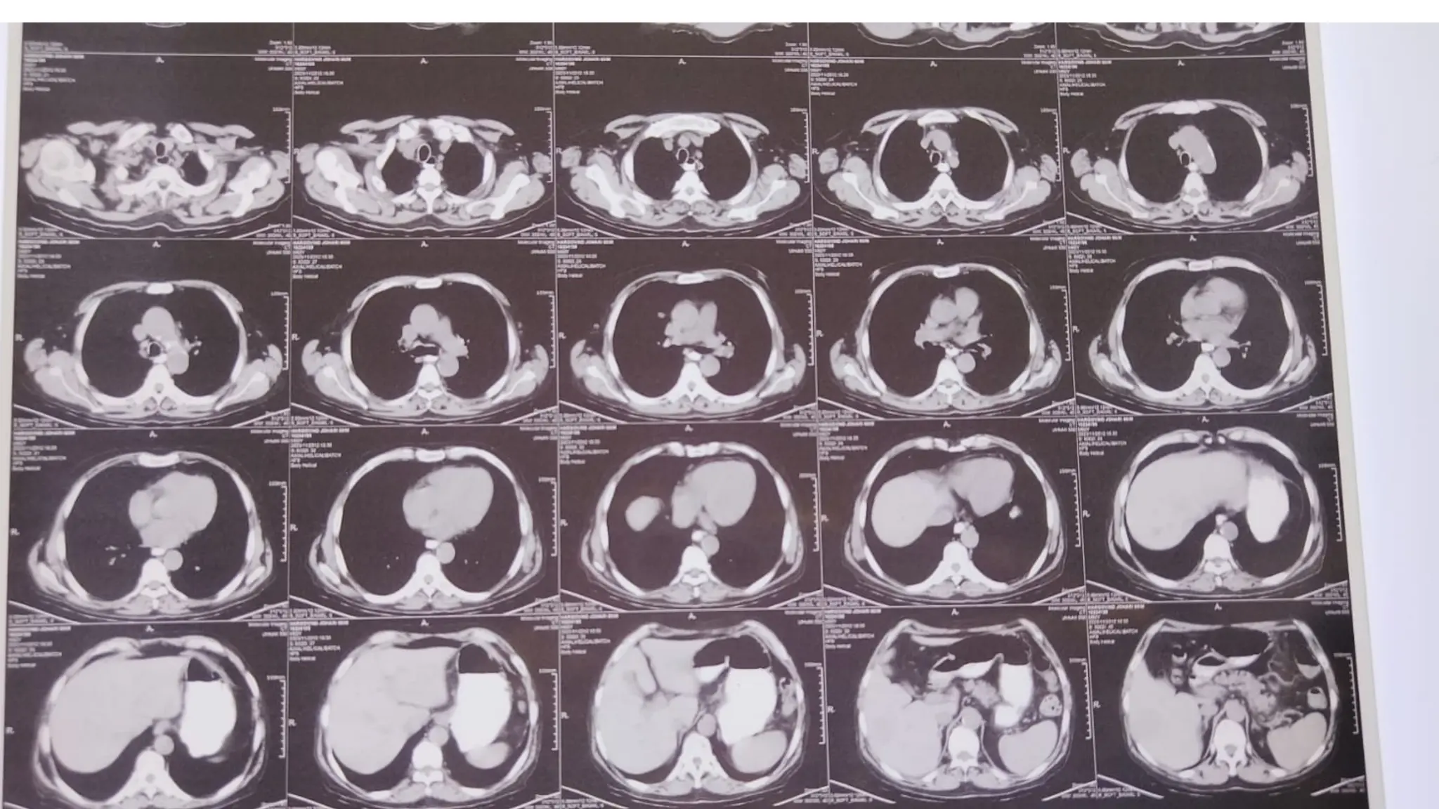 carcinomal of GEJ case presentation.pptx