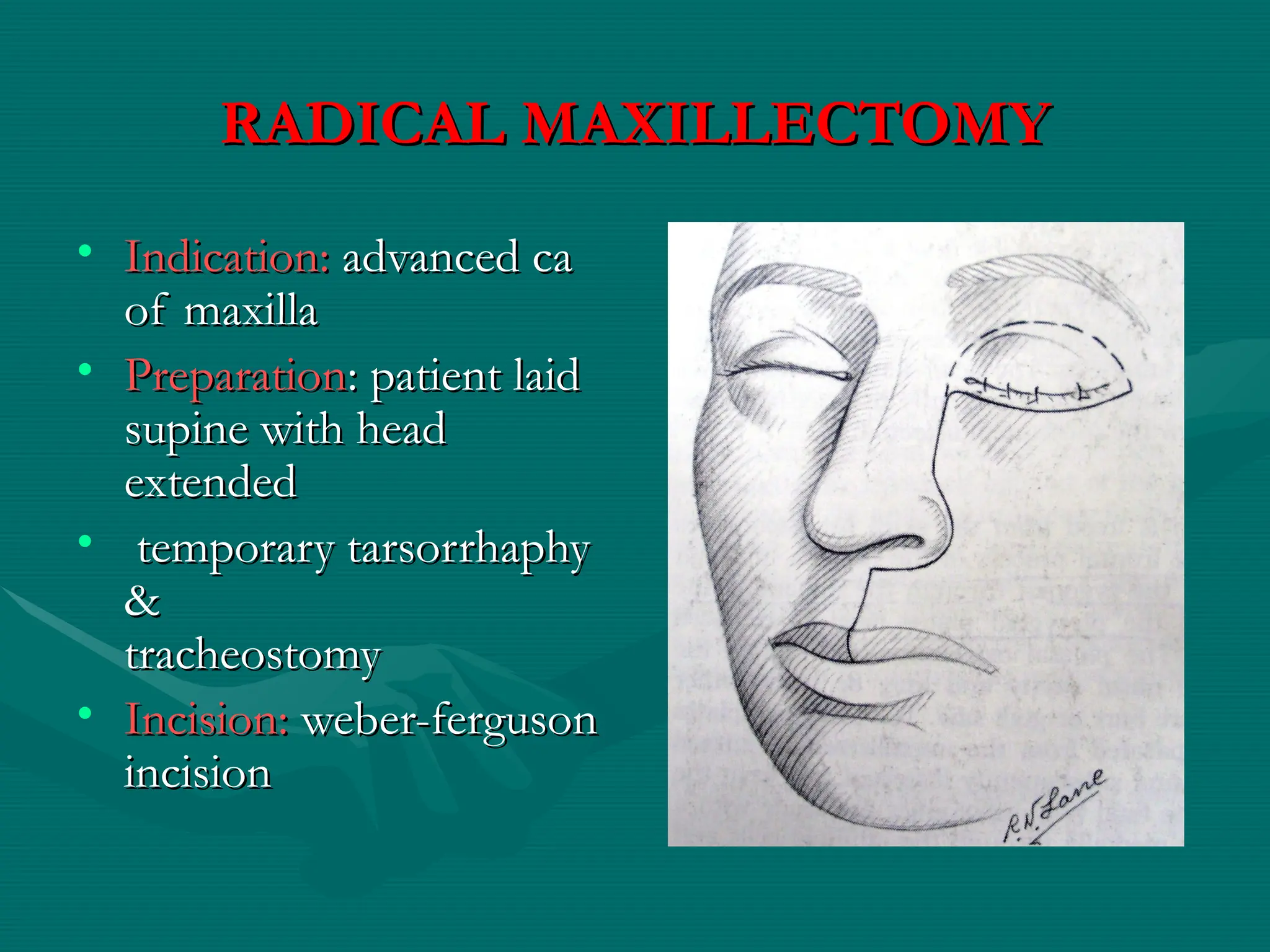 CARCINOMA MAXILLA clinical features and managment.ppt