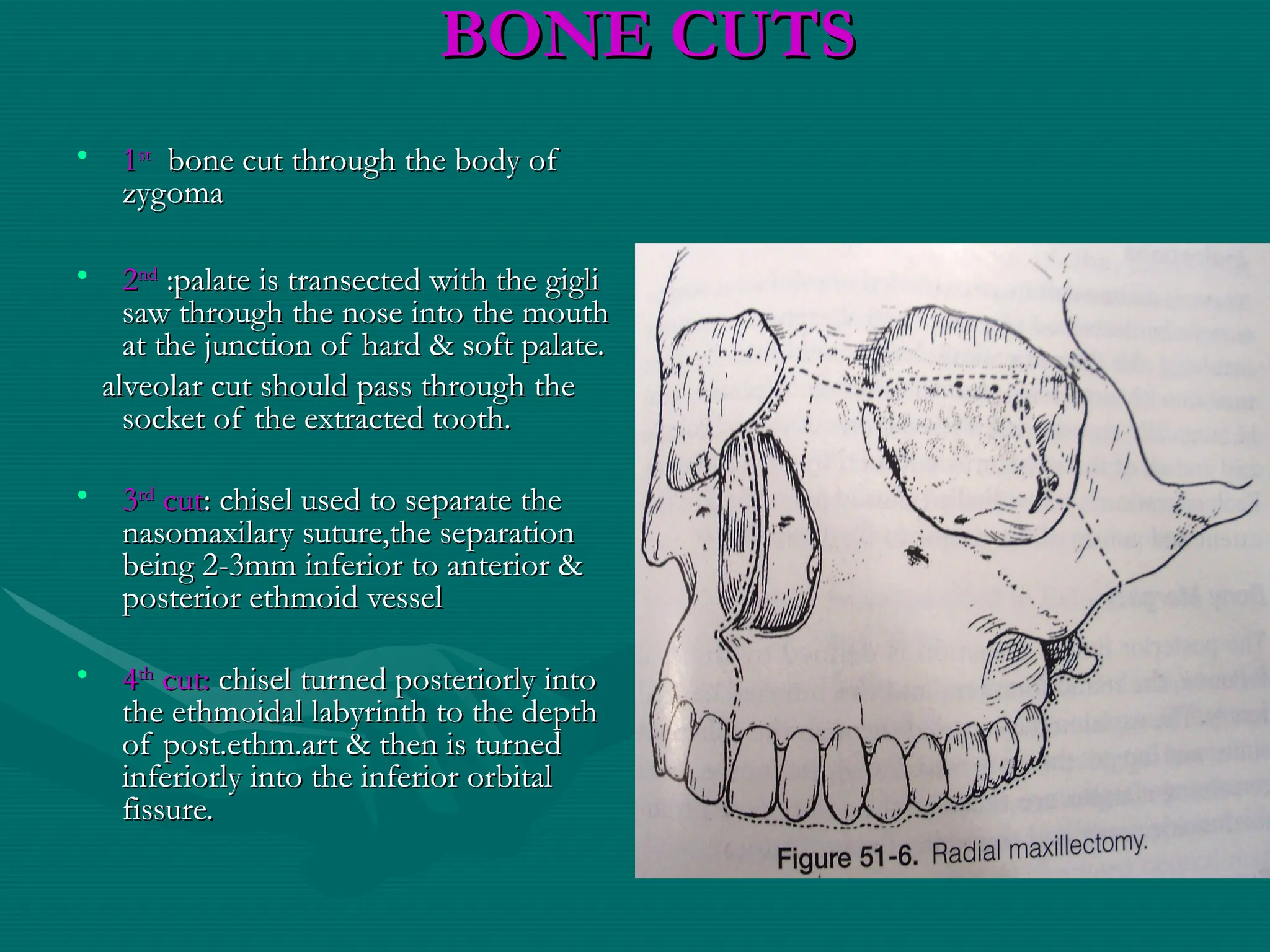 CARCINOMA MAXILLA clinical features and managment.ppt