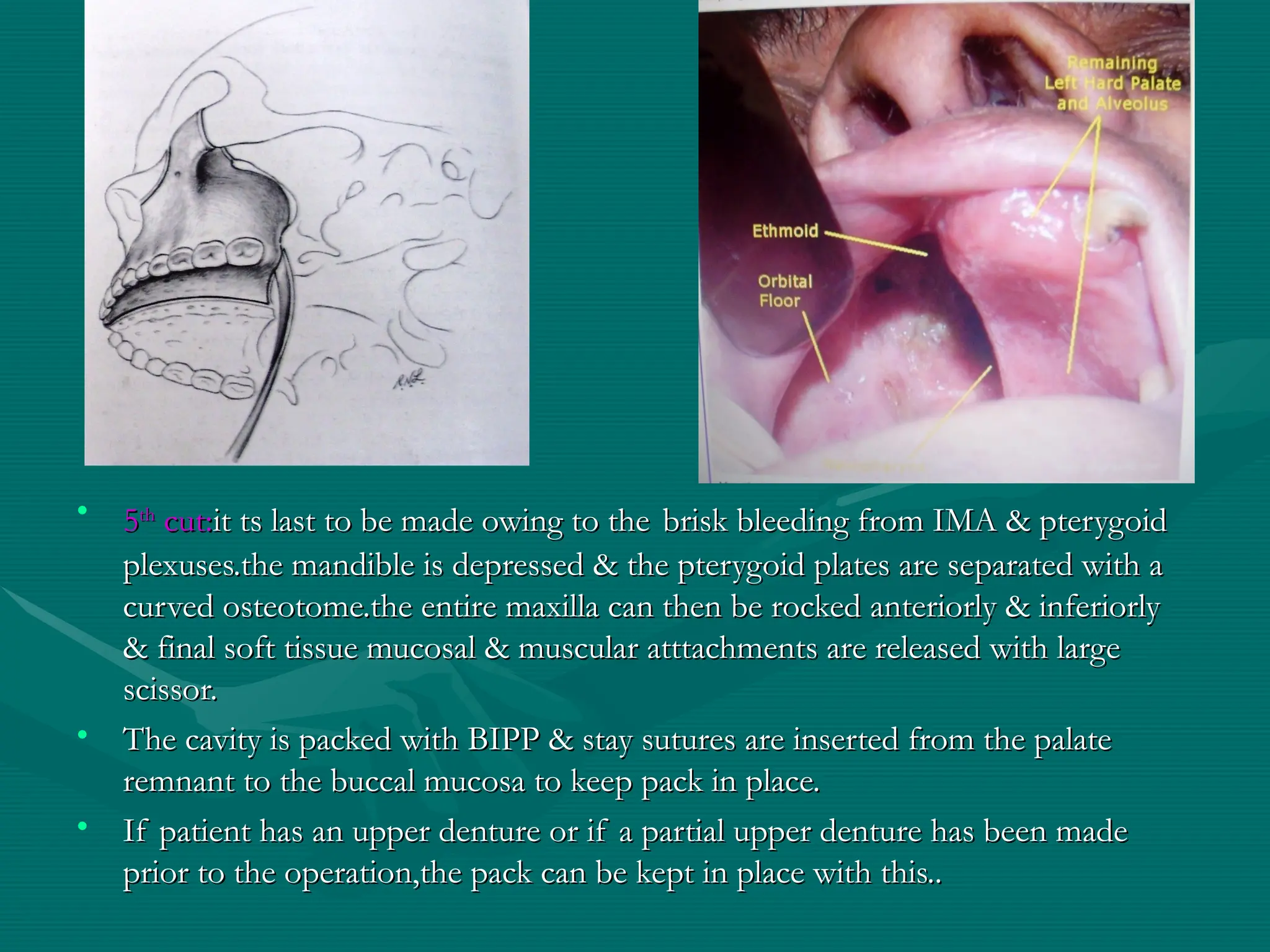 CARCINOMA MAXILLA clinical features and managment.ppt