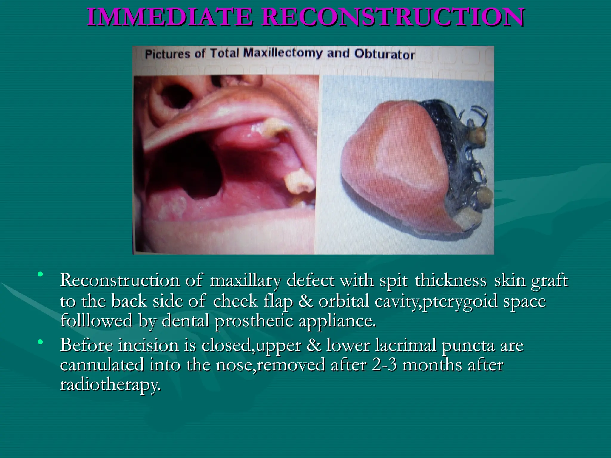 CARCINOMA MAXILLA clinical features and managment.ppt