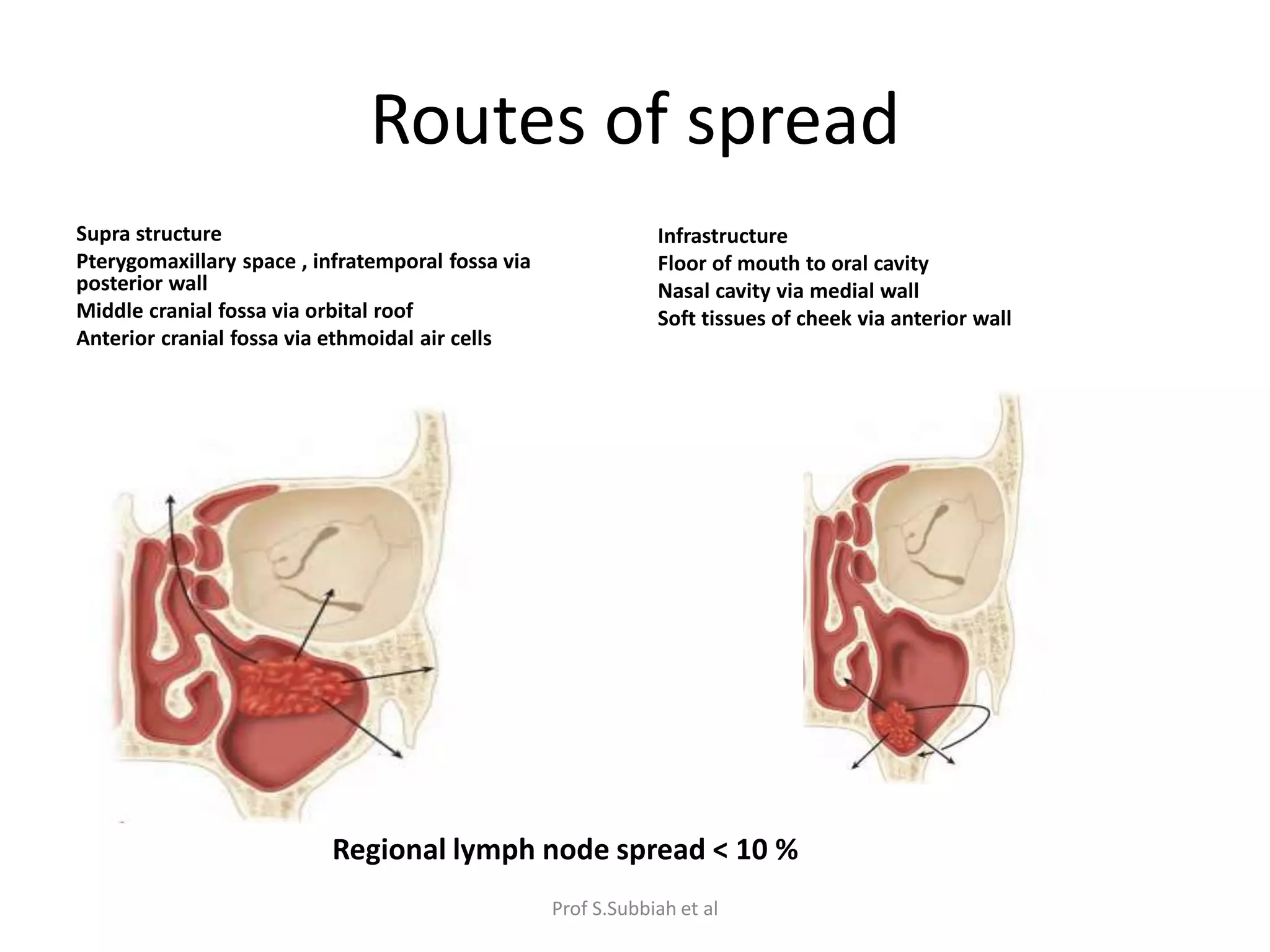 Carcinoma Maxillary sinus | PPTX